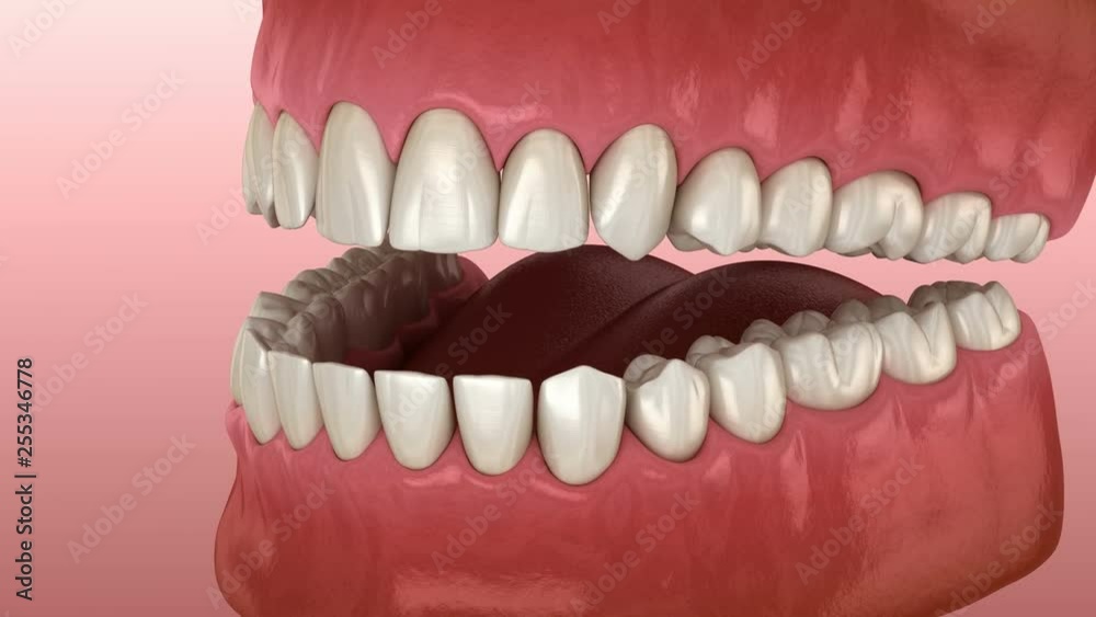 Underbite dental occlusion ( Malocclusion of teeth ). Medically ...