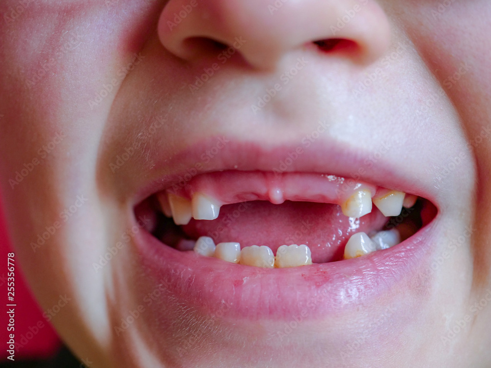 Portrait of funny child in new glasses with patch for correcting squint ...