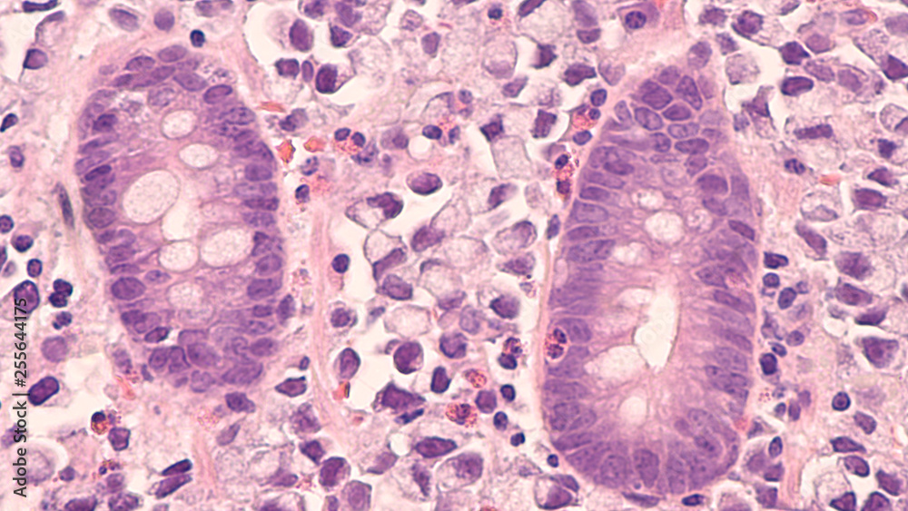 Signet Ring Type Colorectal Cancer at Ruby Najar blog