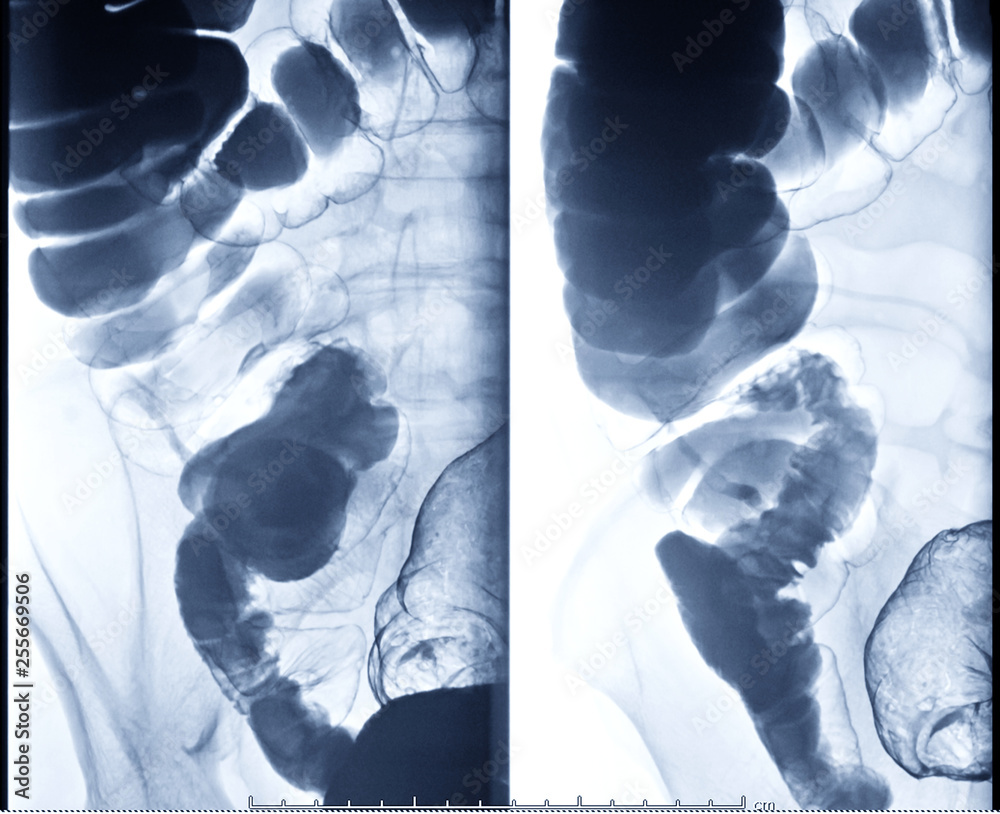 barium enema image or x-ray image of large intestine or colon showing ...
