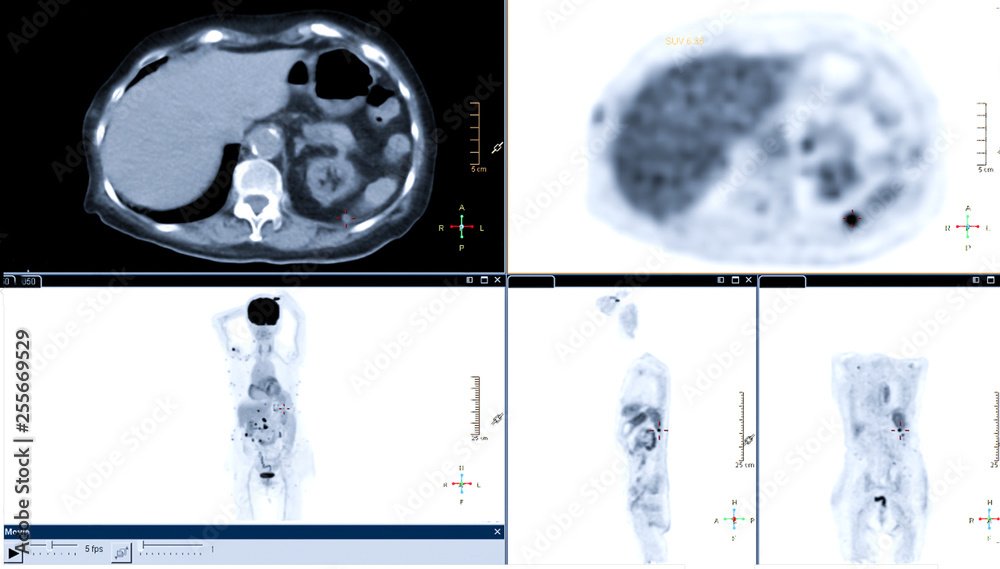 Foto de PET Scan image of whole body Comparison Axial , Coronal and ...