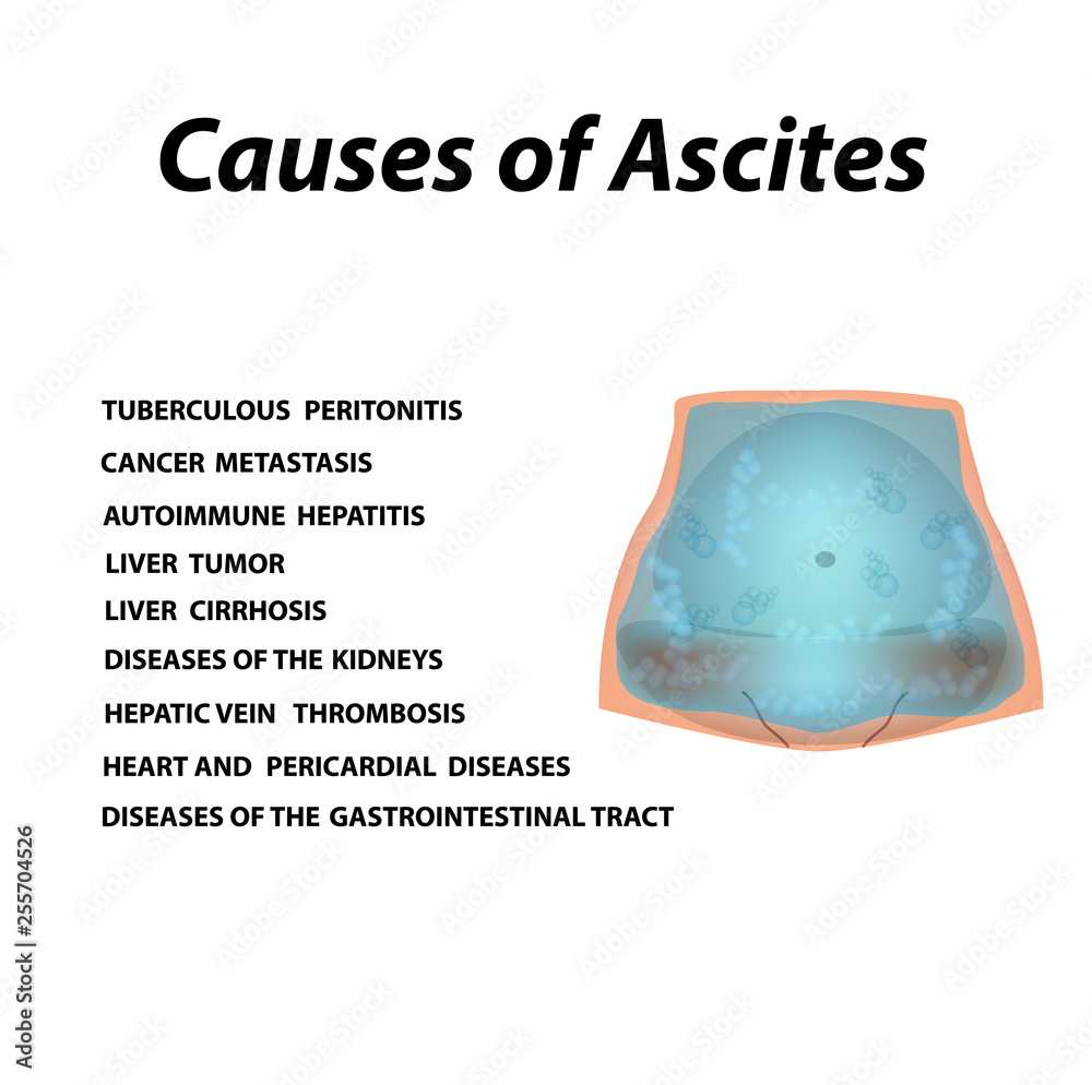 Ascites Free fluid in the abdominal cavity. Infographics. Vector ...