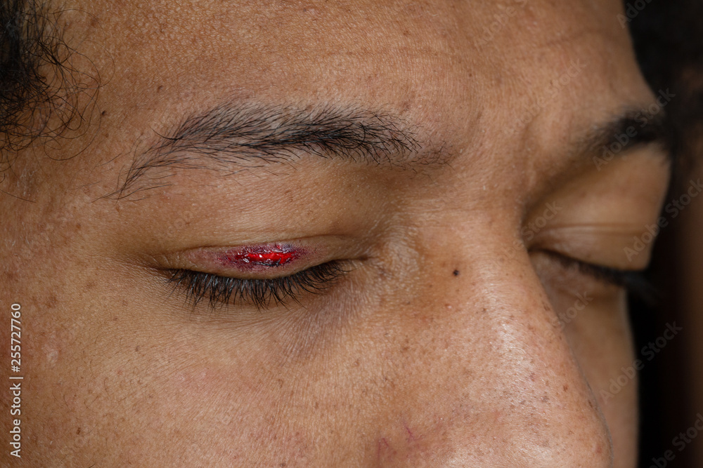 Wound to an eyelid of the eye following blepharoplasty Stock Photo ...