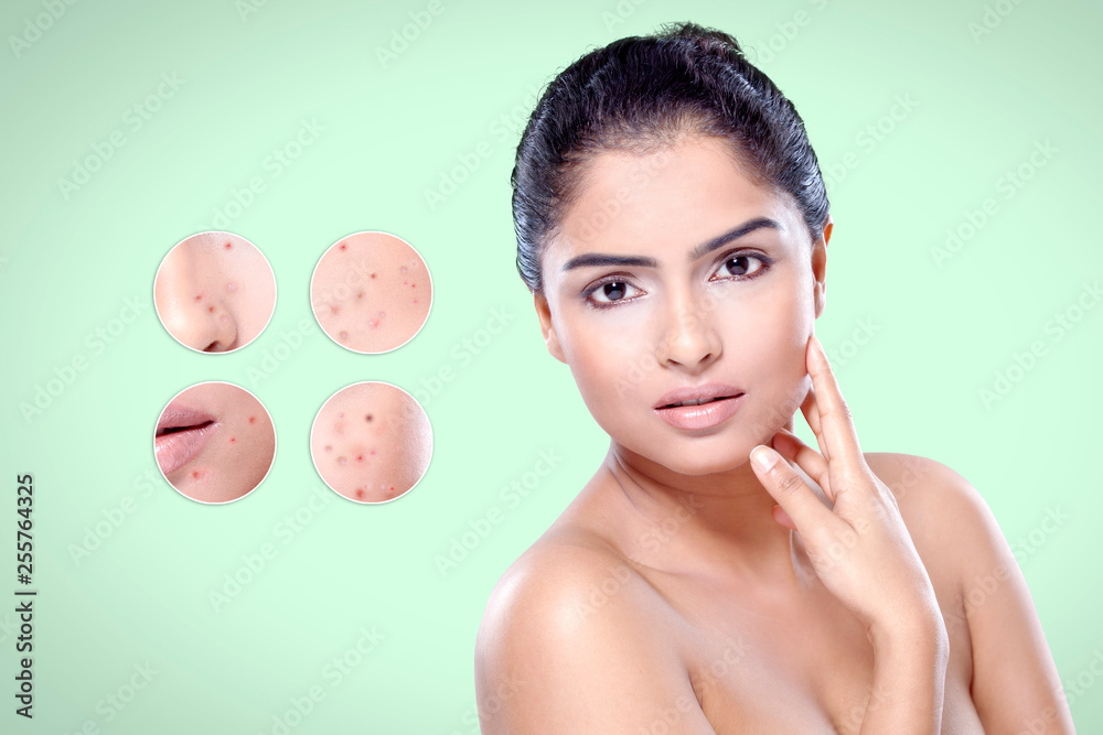 Indian woman with acne marks and after treatment Stock Photo | Adobe Stock