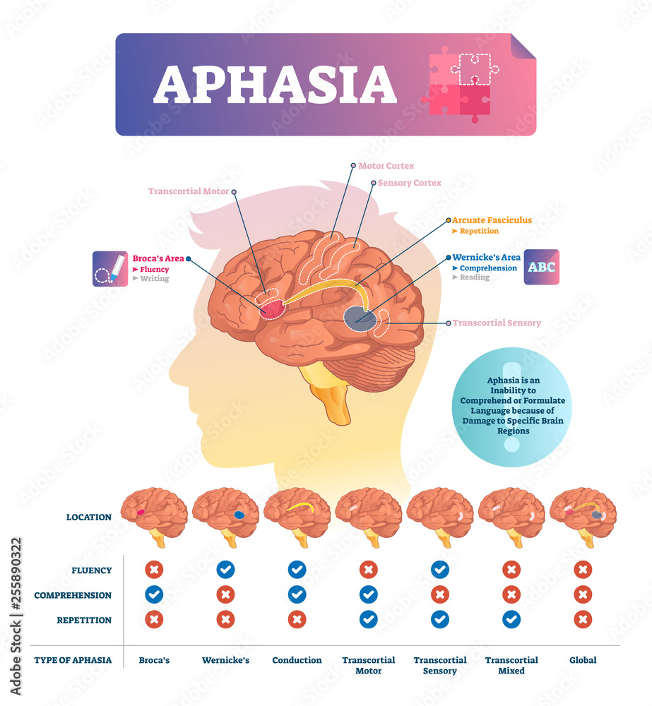 Aphasia vector illustration. Labeled educational scheme with brain ...