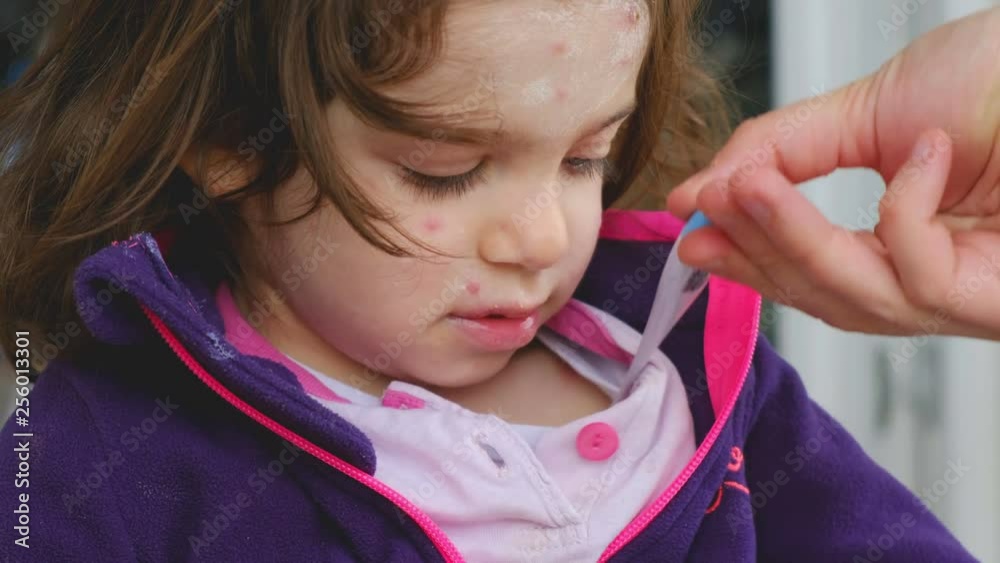 take child temperature fever with thermometer chicken pox varicella ...