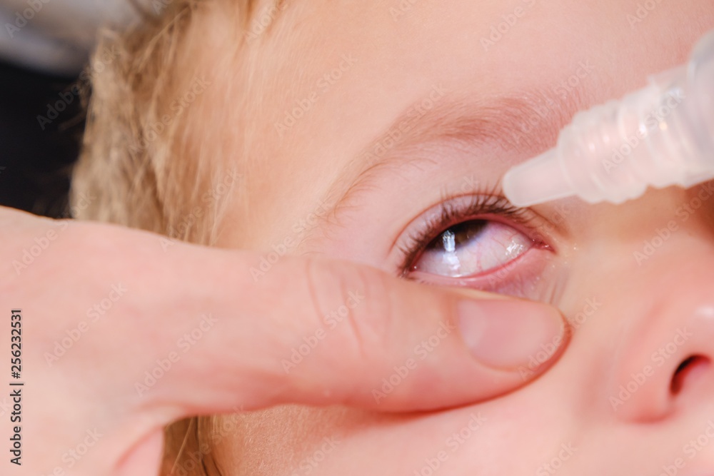 Eye child allergy and conjunctivitis red allergic, pollen. Stock Photo ...