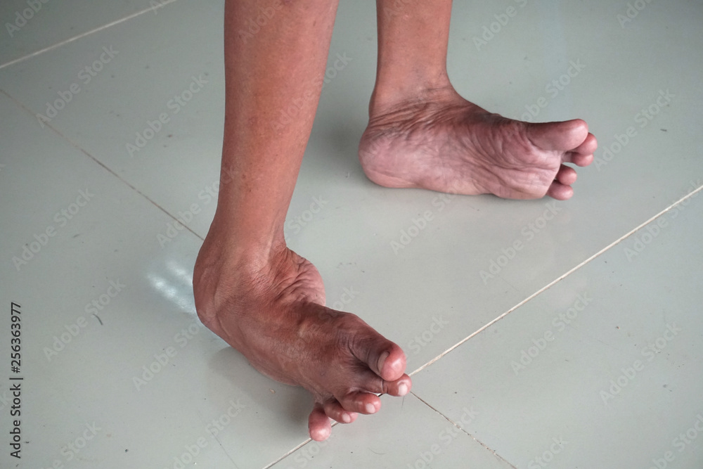Two feet showing abnormalities Congenital called clubfoot or club foot ...