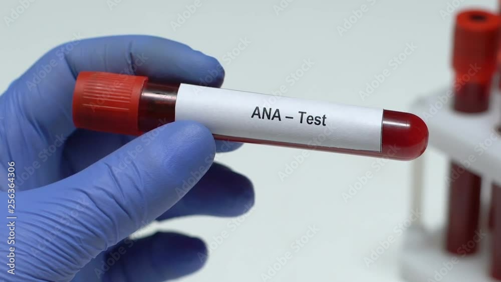 ANA-Test, doctor holding blood sample in tube close-up, health ...