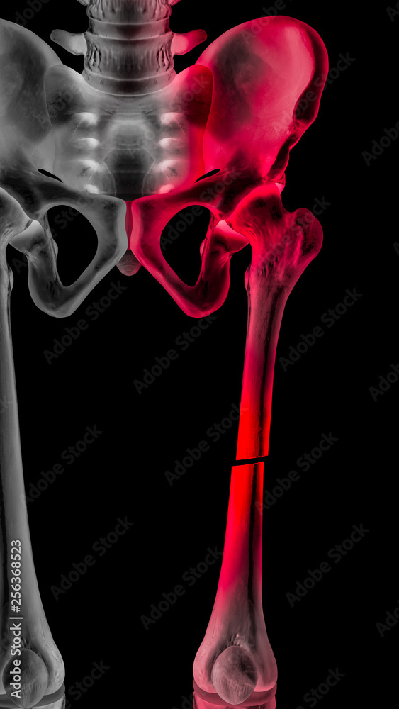 X-ray of broken upper leg or femur fracture anterior view completed ...