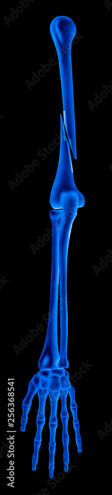X-ray of the humerus fractures or broken arms completed displaced ...