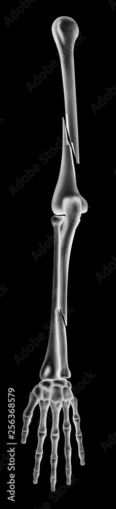 X-ray of ulna and Humerus Fractures or Broken Arms- Completed displaced ...