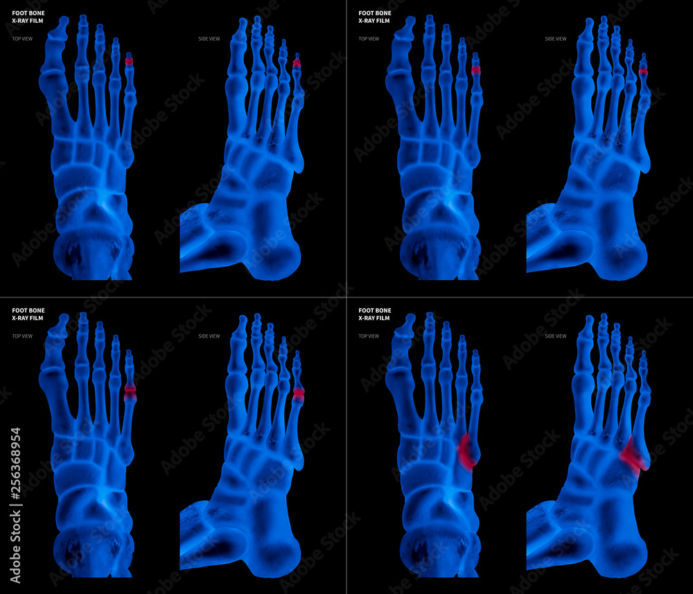 X-ray of collection arthritis little toe joint foot bone red highlights ...