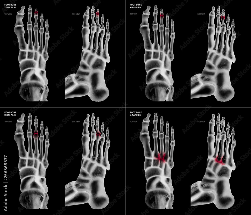 X-ray of collection arthritis middle toe joint foot bone red highlights ...