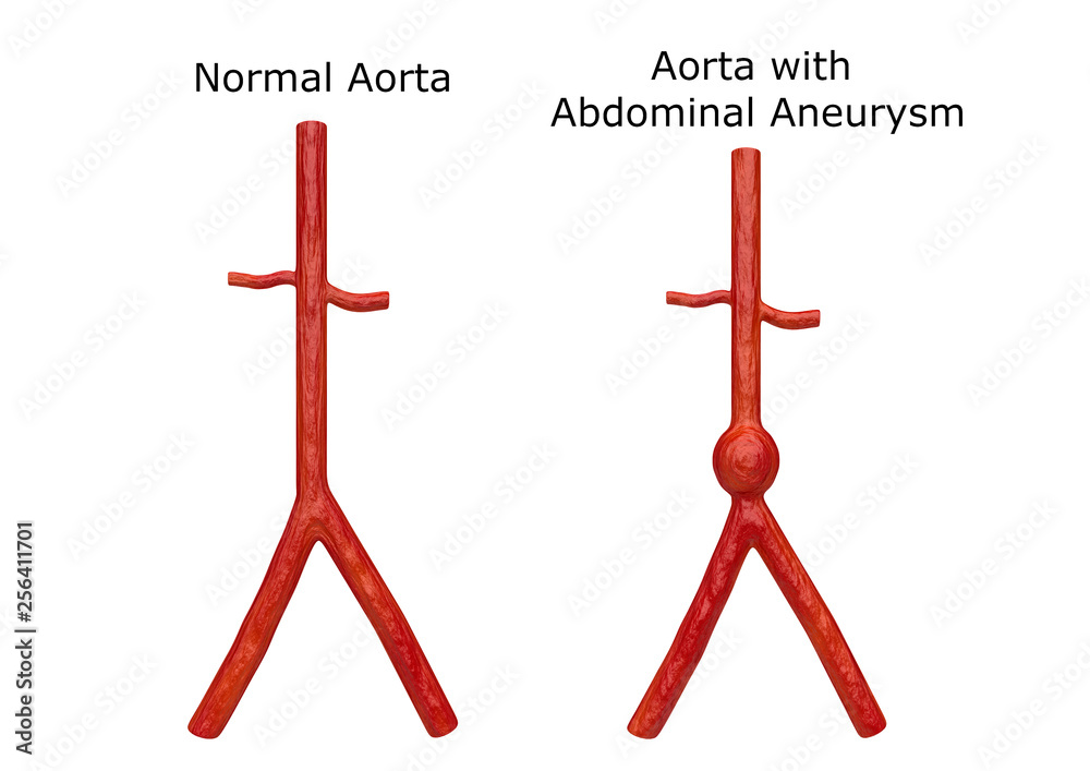 Plakat Internal view of the human body demonstrating a normal aorta and ...