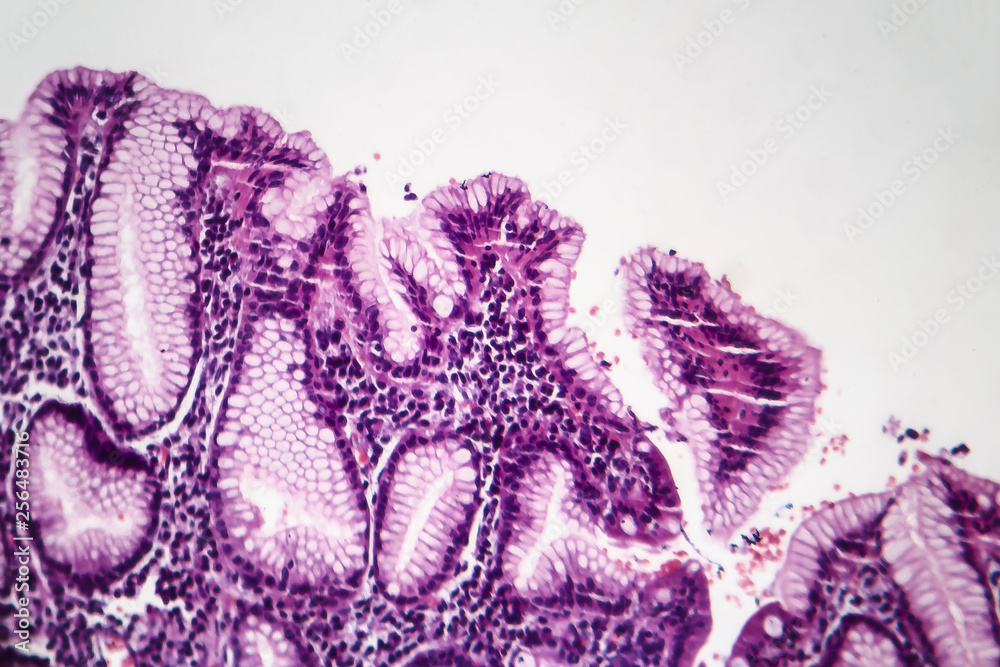 Histopathology of chronic superficial gastritis, light micrograph ...