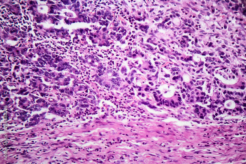 Gastric adenocarcinoma, light micrograph, photo under microscope Stock ...