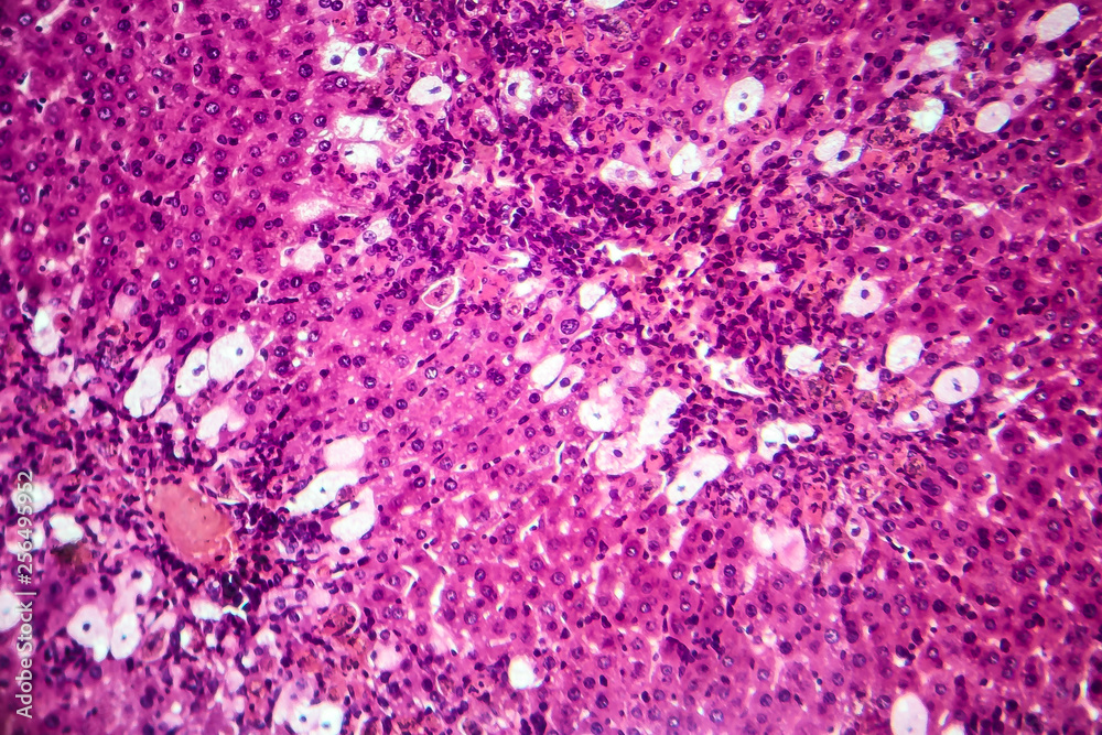 Viral hepatitis, light micrograph, photo under microscope Stock ...