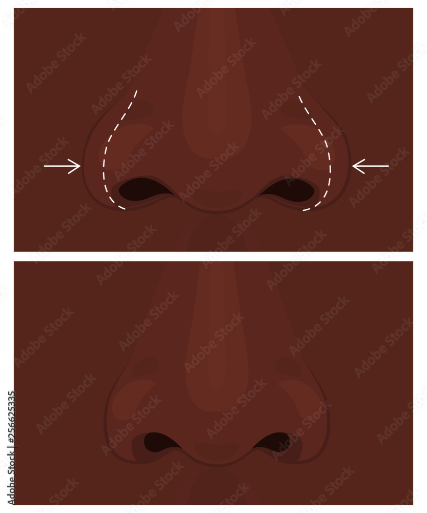 Vector illustration. Front view of a wide human nose before, after ...
