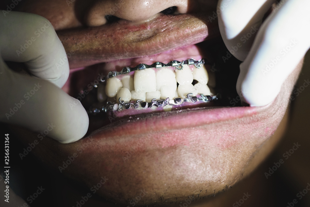 Metal dentist tool wiring fractured mandible and jaws. Bars are wired ...