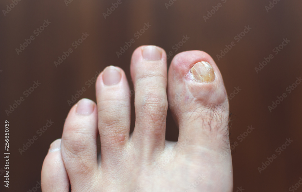 Medical photo: a deformed toe and skin condition - left foot. Old ...