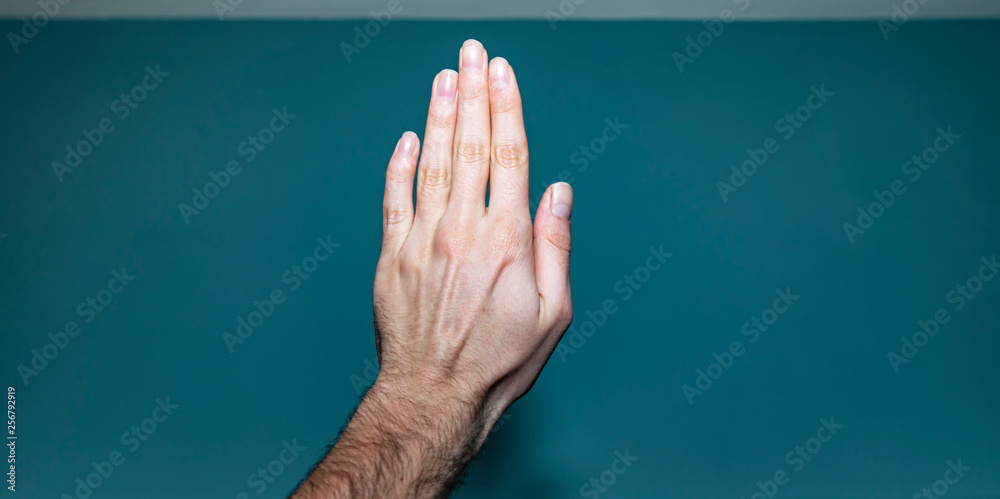 Left Hand With Broken Finger And Ganglion Cyst Stock Photo | Adobe Stock