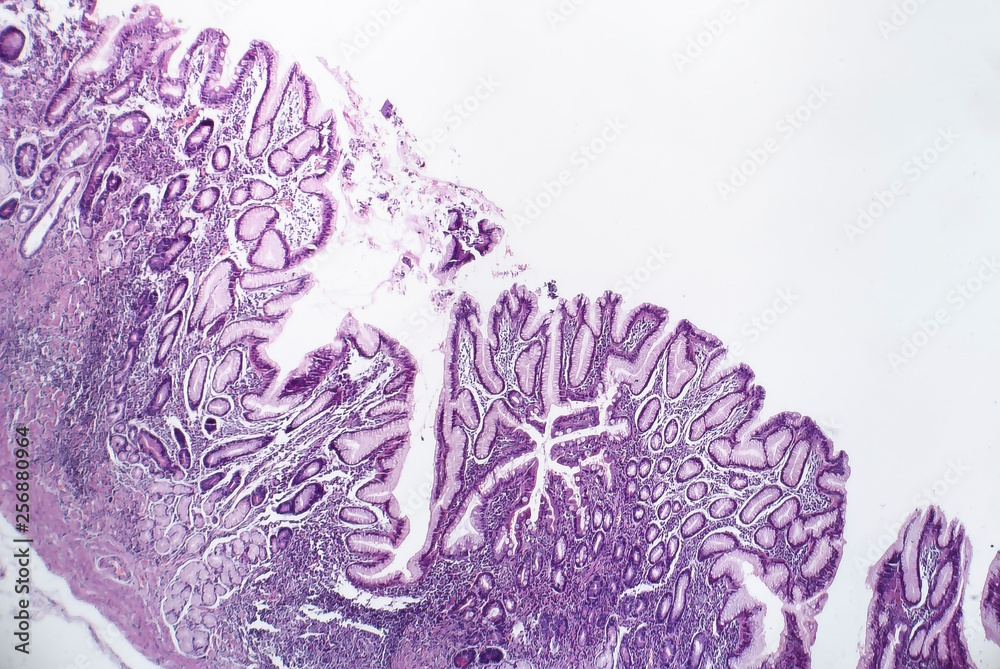 Histopathology of chronic superficial gastritis, light micrograph ...