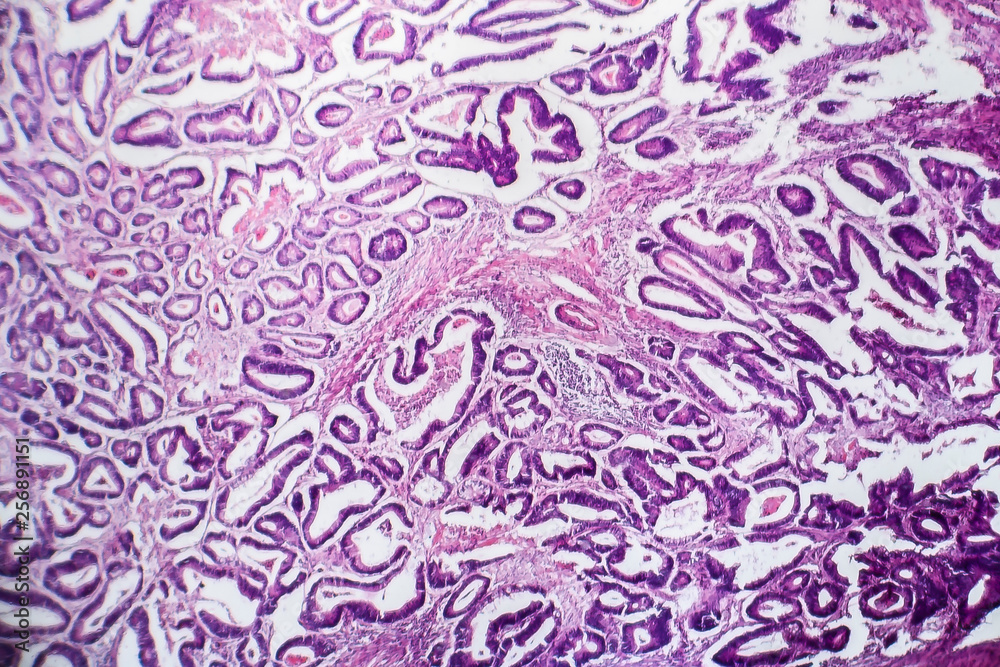 Colon cancer, light micrograph, photo under microscope Stock ...