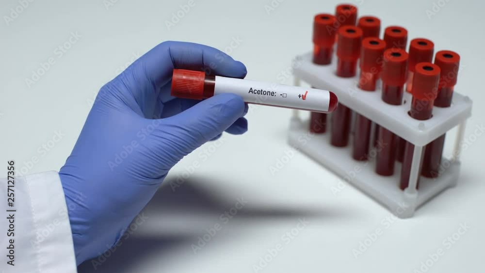 Positive Acetone test, doctor showing blood sample, lab research ...