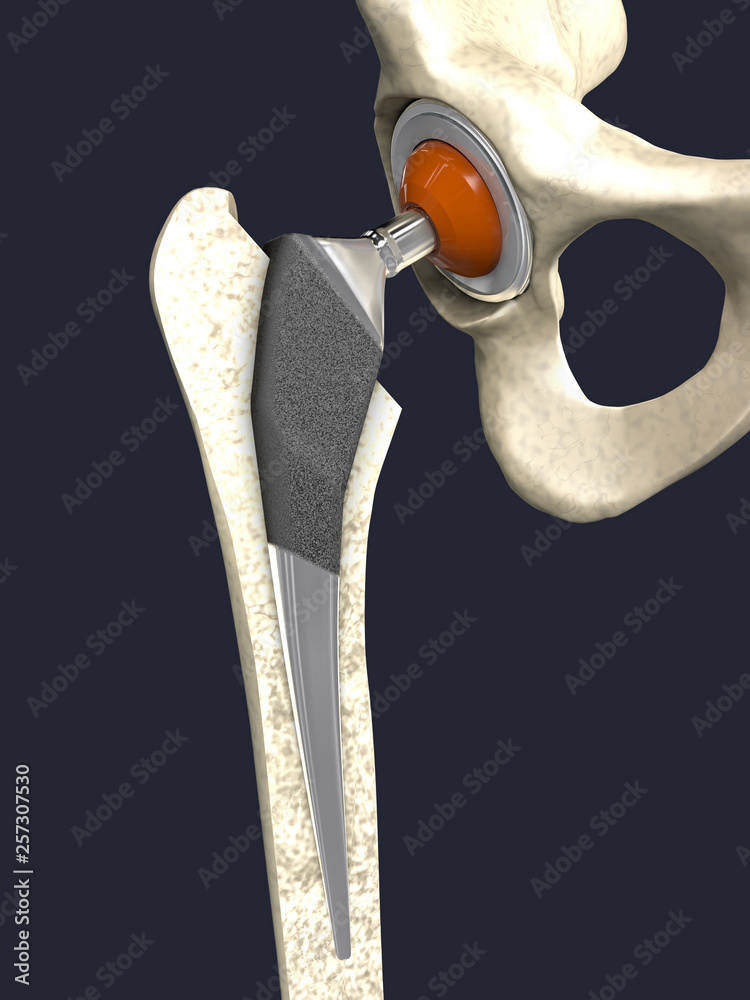 Function of a hip joint implant or hip prosthesis in frontal view - 3d ...