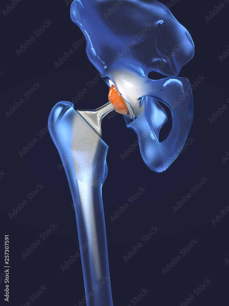 Function of a hip joint implant or hip prosthesis in frontal view - 3d ...