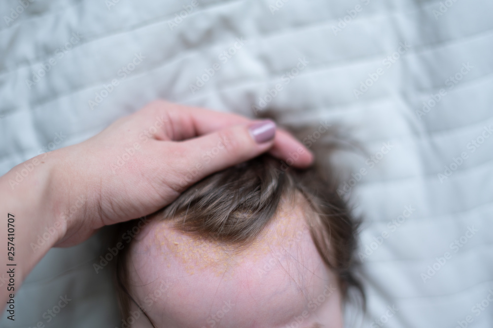 Seborrheic dermatitis on head of the baby. Newborn with seborrhea ...