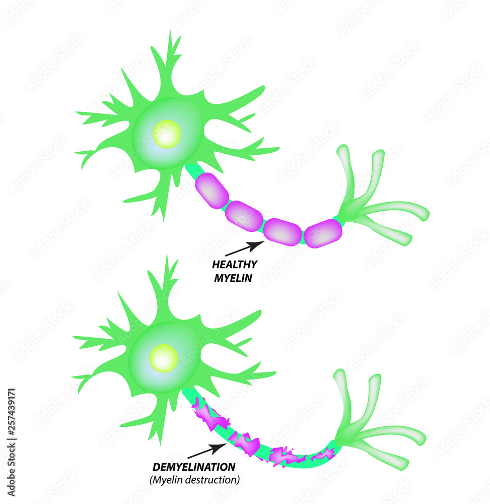 Multiple Sclerosis Neuron