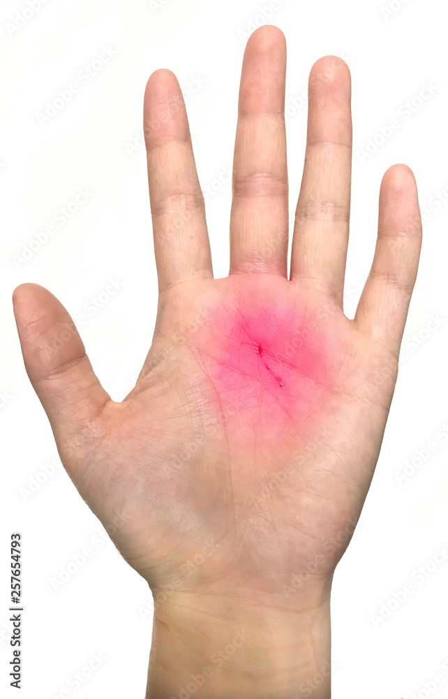 A lesion in palm is caused by sharp weapon graze and making scar soon ...
