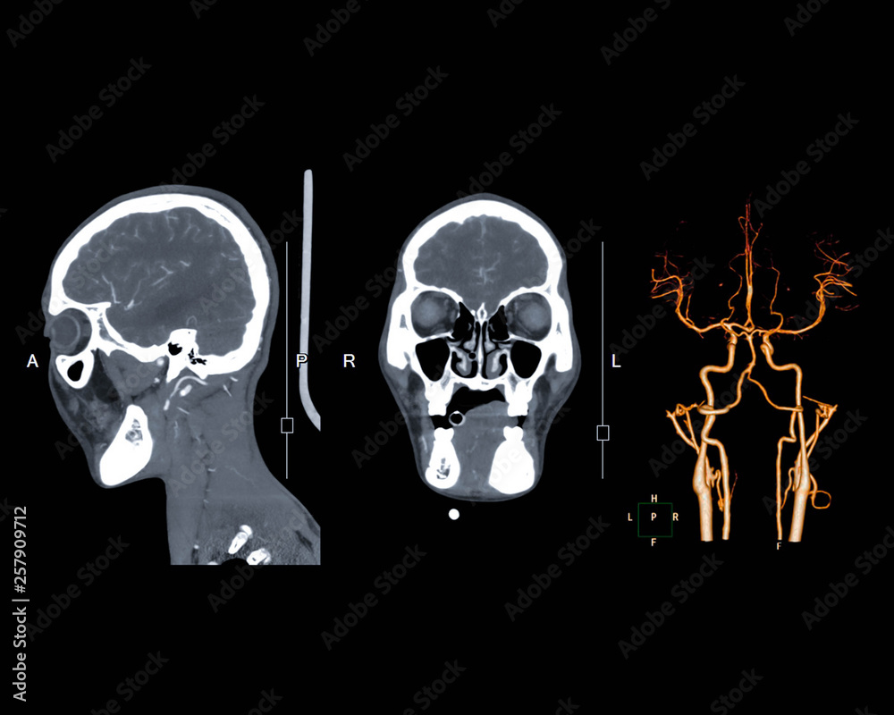 CTA brain sagittal ,coronal and 3D Rendering image , for finding Stroke ...