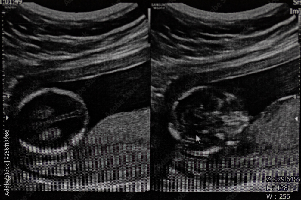 Ultrasound of baby in mother's at hospital. Stock Photo | Adobe Stock