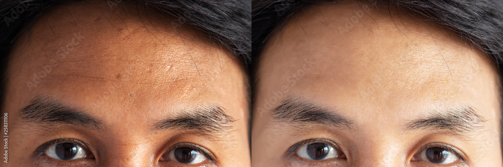 two pictures compared effect Before and After treatment. skin with ...