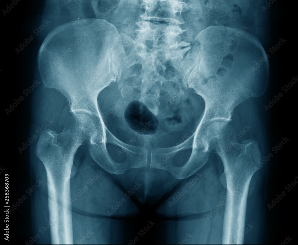 old man x-ray, lumbar x-ray image with pelvic bone Stock Photo | Adobe ...