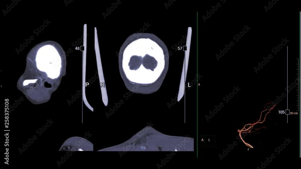 Video Stock CTA brain or Computed tomography angiography of the brain ...