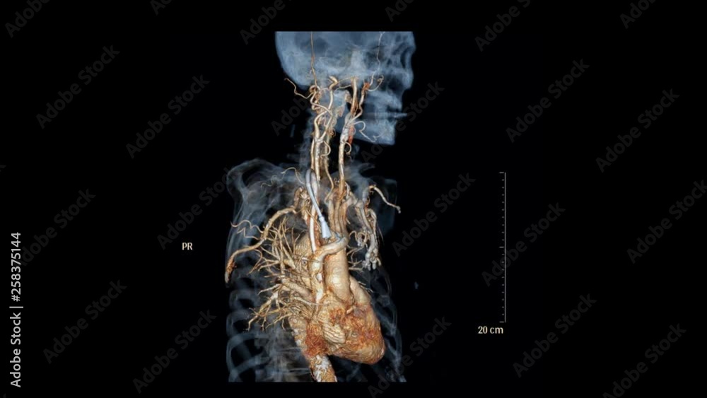 Dialysis Catheter In Carotid Artery at Joshua Matos blog