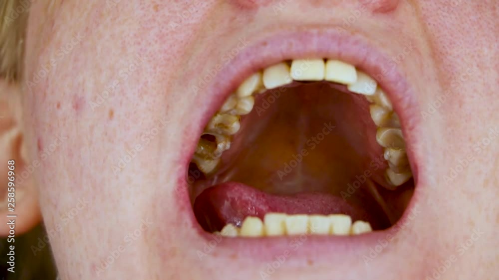 The hole in the tooth and the treatment of dental canals. Treatment of ...