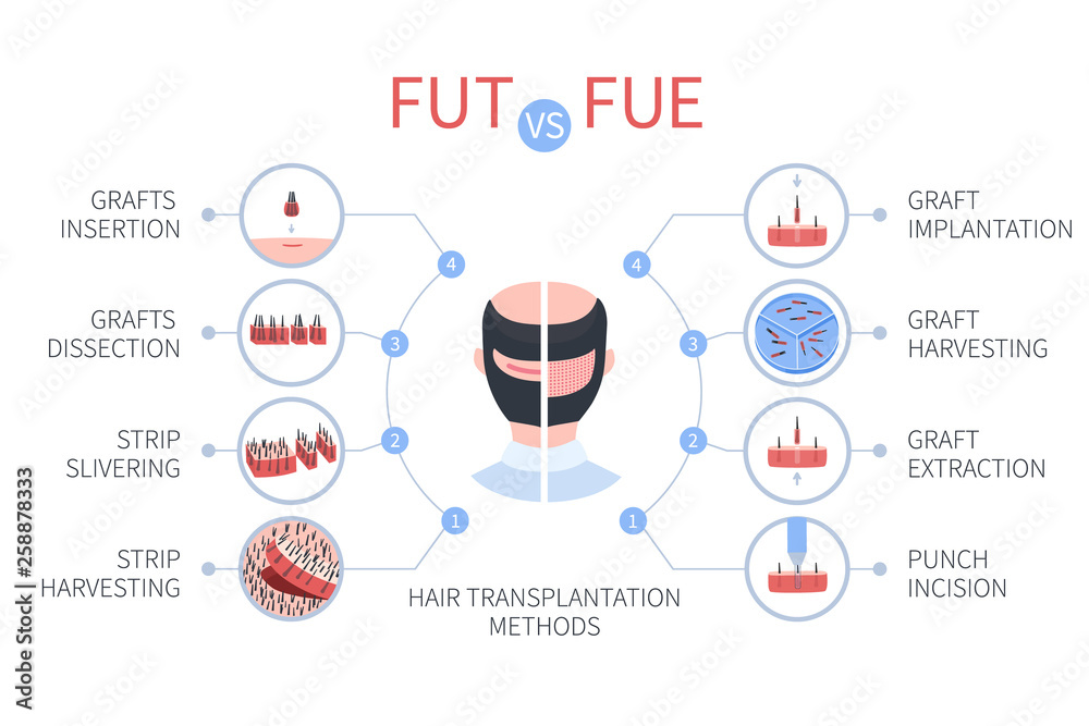 Fue Vs Fut Medical Infographics Follicular Unit Extraction Versus