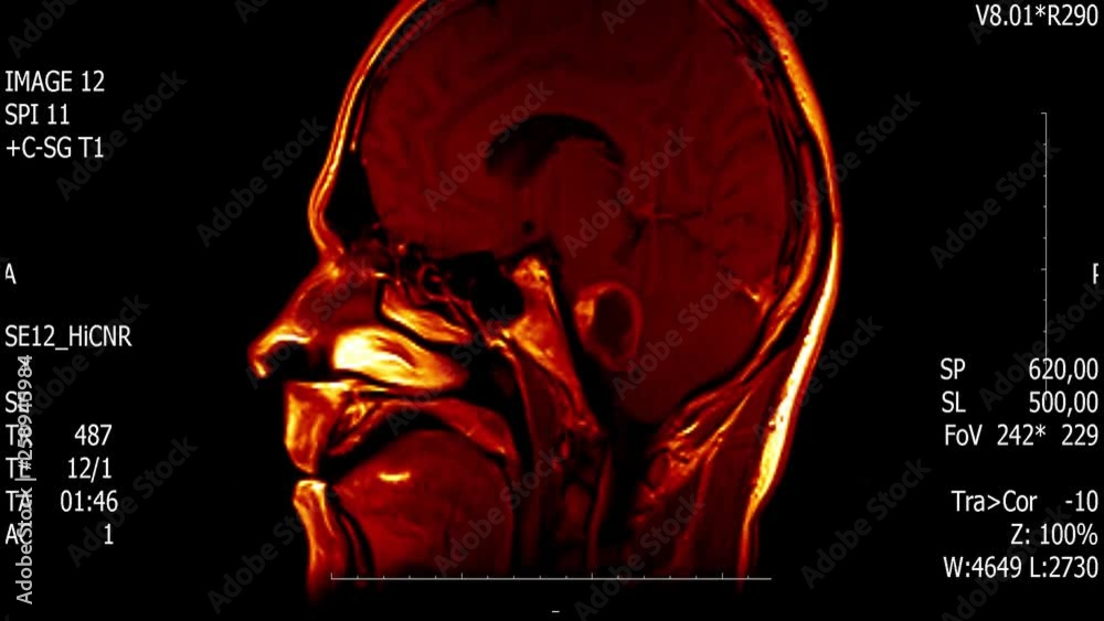 Real life man brain mri scan with tumor neoplasm medical reseach new ...