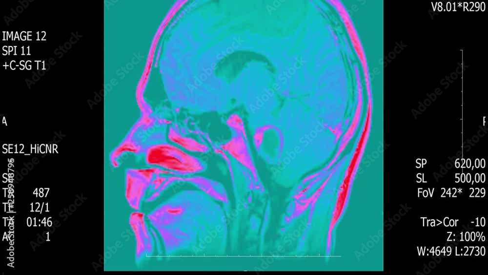 Real life man brain mri scan with tumor neoplasm medical reseach new ...