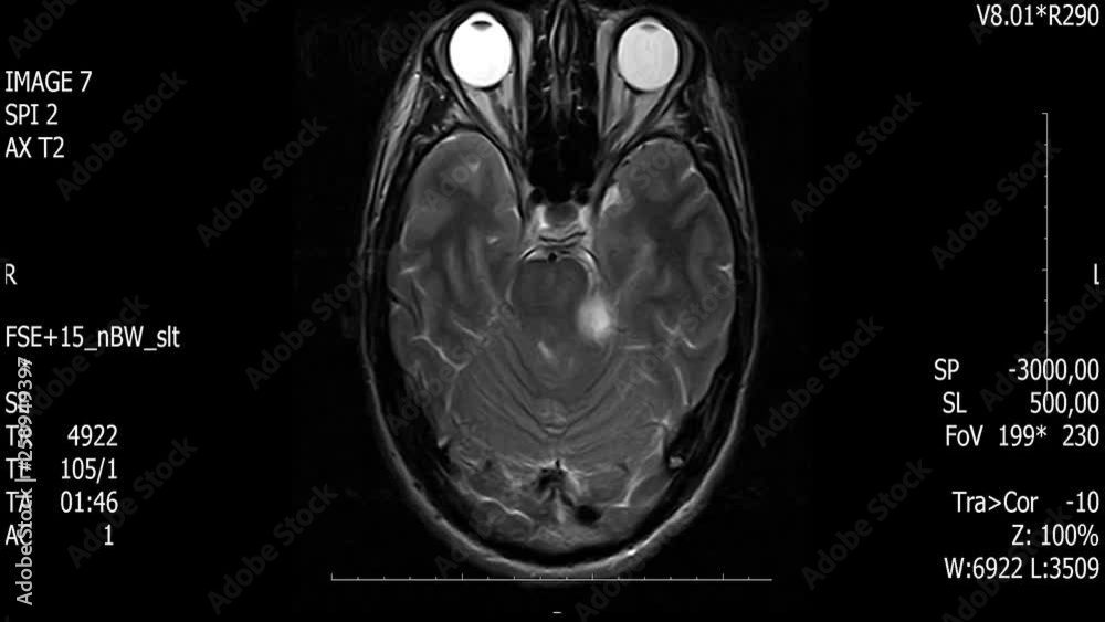Real life man brain mri scan with tumor neoplasm medical reseach new ...