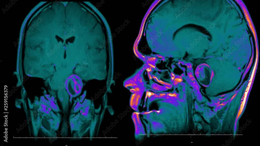 Real life man brain mri scan with tumor neoplasm medical reseach new ...