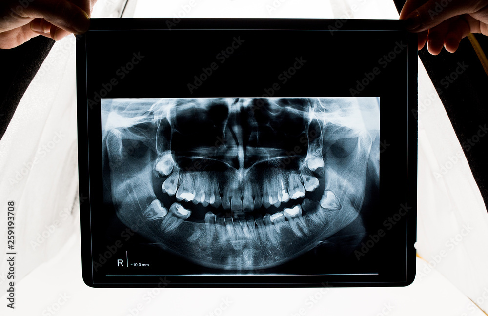 A panoramic dental x-ray hold in front of bright light so the doctor ...