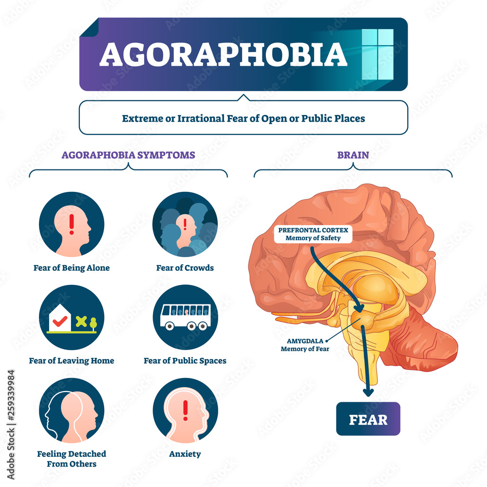 Agoraphobia vector illustration. Labeled anatomical fear explanation ...