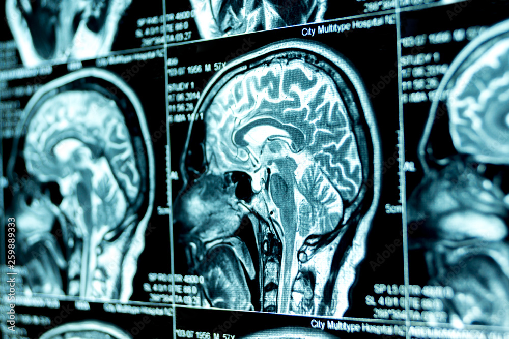 MRI scan of the brain Stock Photo | Adobe Stock