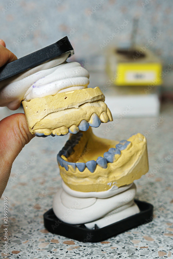 Dental impressions of teeth for manufacture of prostheses and ...